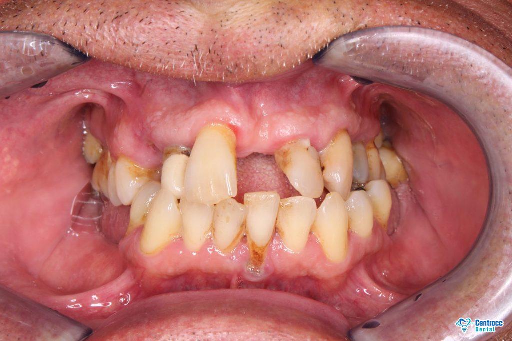 Zahnfleischentzündung (Gingivitis): Wie erkennt und behandelt man ...