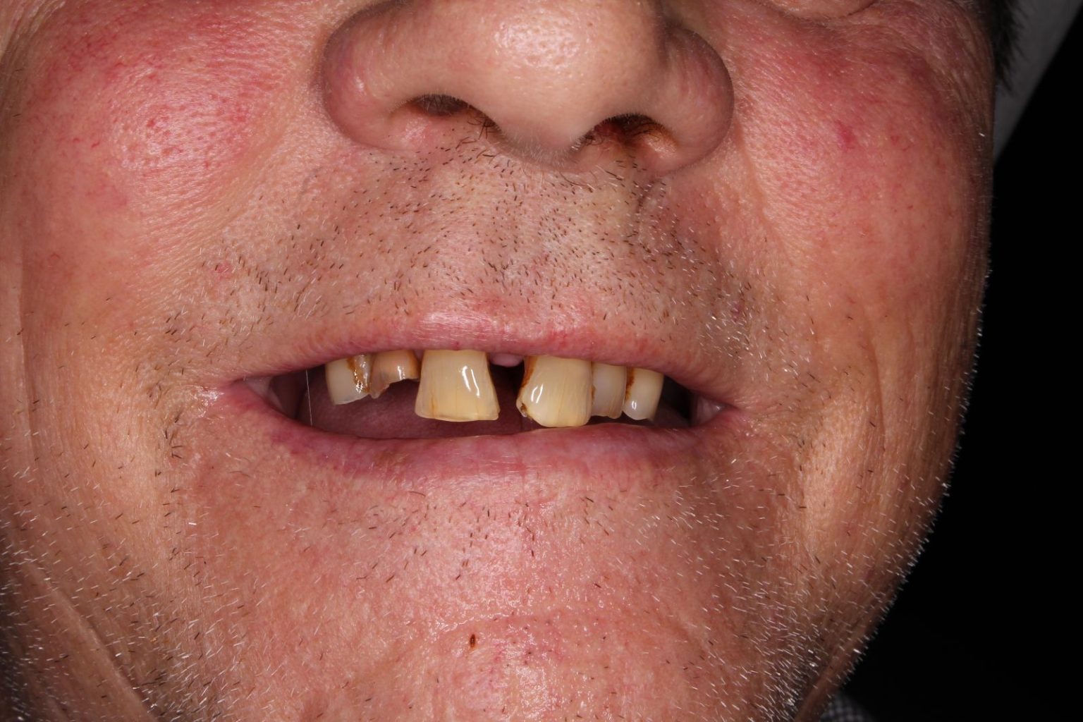 Parodontitis: Wie man erkennt und heilt? | Centrocc Dental